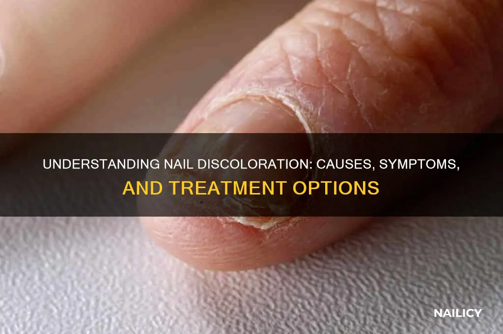 Understanding Nail Discoloration: Causes, Symptoms, And Treatment ...
