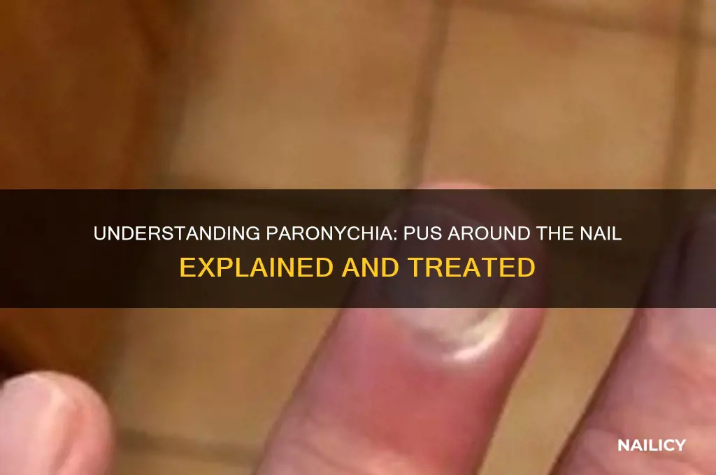 Understanding Paronychia: Pus Around The Nail Explained And Treated ...