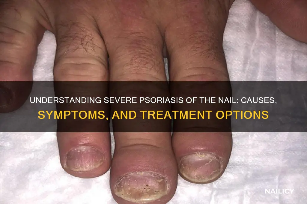Understanding Severe Psoriasis Of The Nail: Causes, Symptoms, And ...