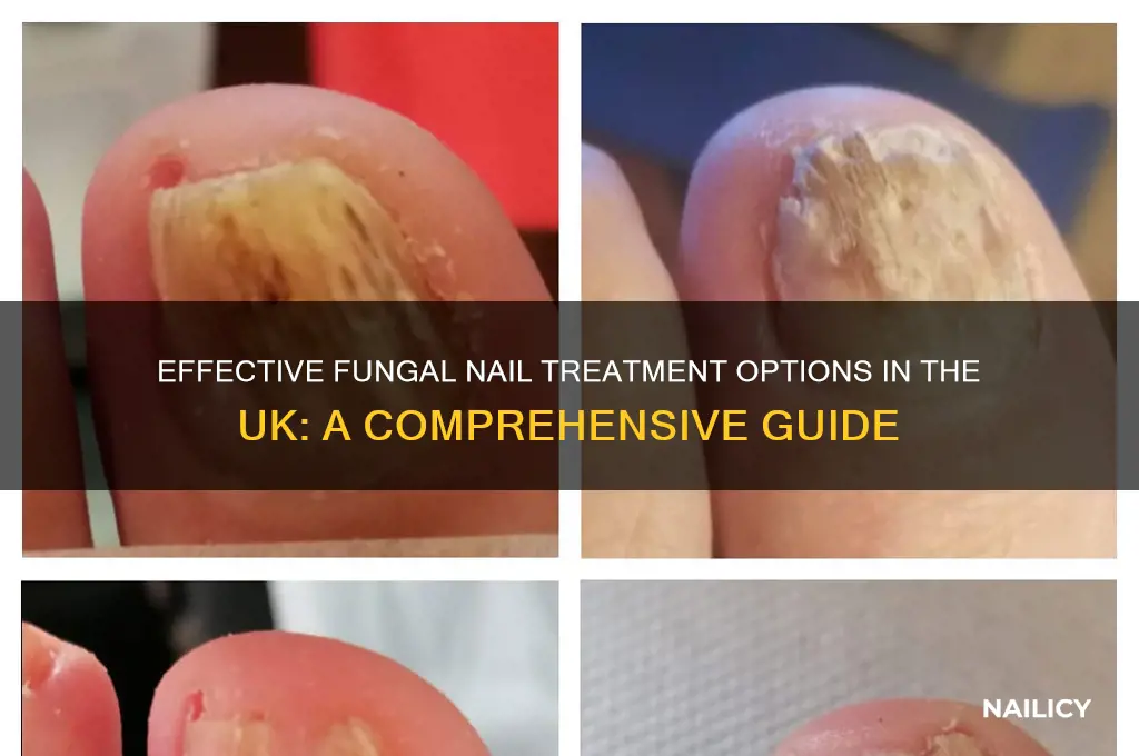 Effective Fungal Nail Treatment Options In The Uk: A Comprehensive ...