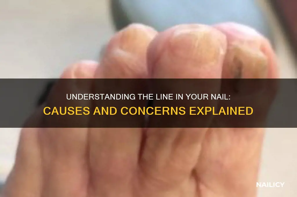 Understanding The Line In Your Nail: Causes And Concerns Explained ...
