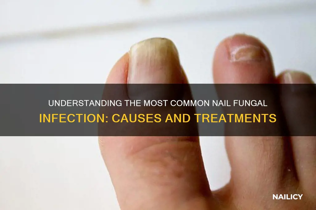 Understanding The Most Common Nail Fungal Infection: Causes And ...
