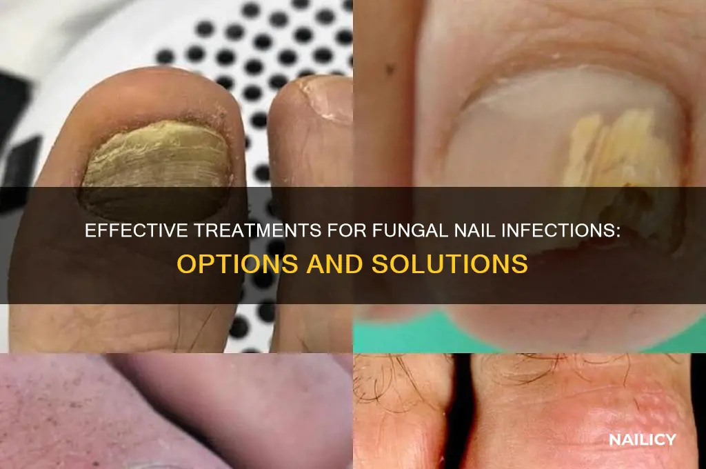 Effective Treatments For Fungal Nail Infections: Options And Solutions ...