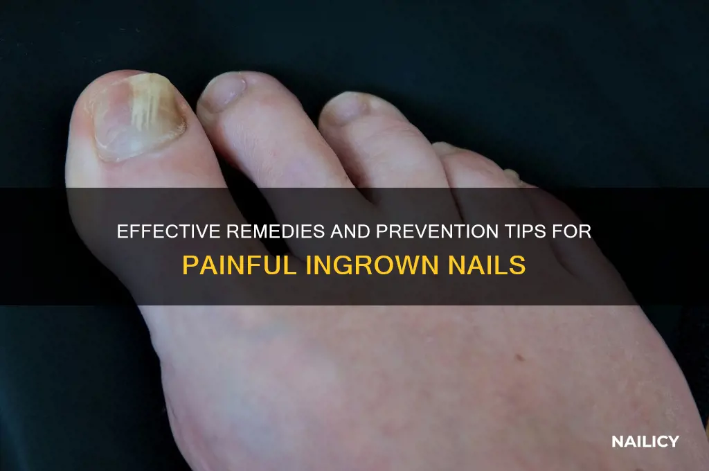 Effective Remedies And Prevention Tips For Painful Ingrown Nails | Nailicy