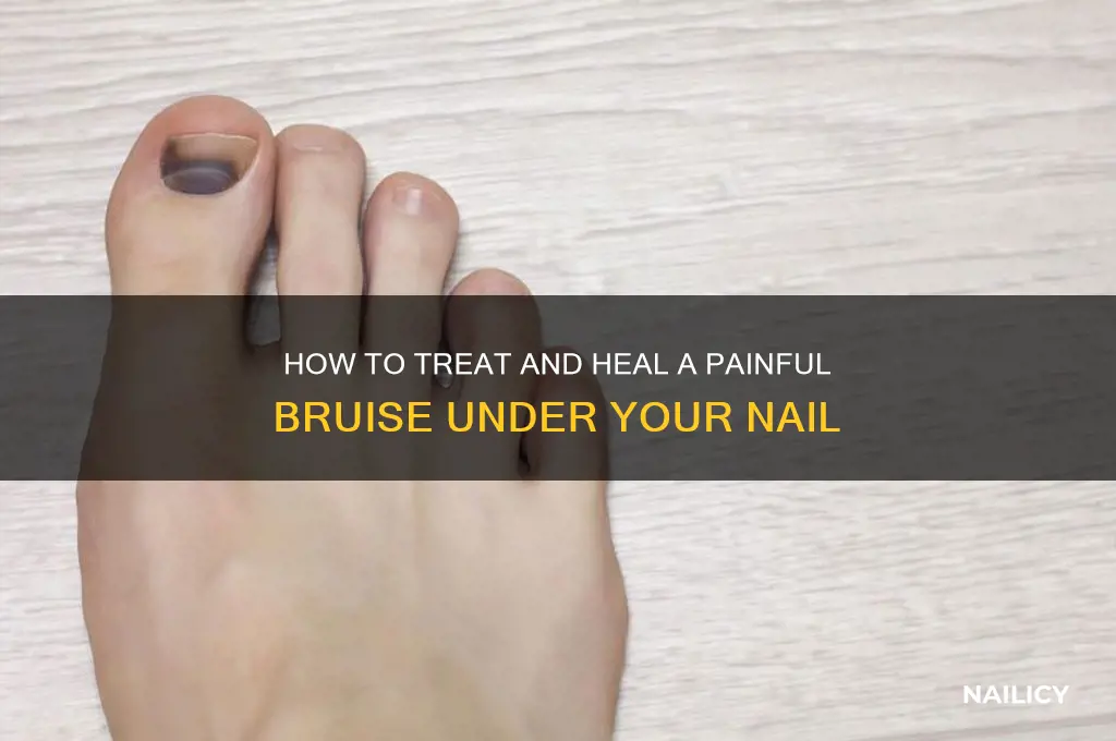 How To Treat And Heal A Painful Bruise Under Your Nail | Nailicy