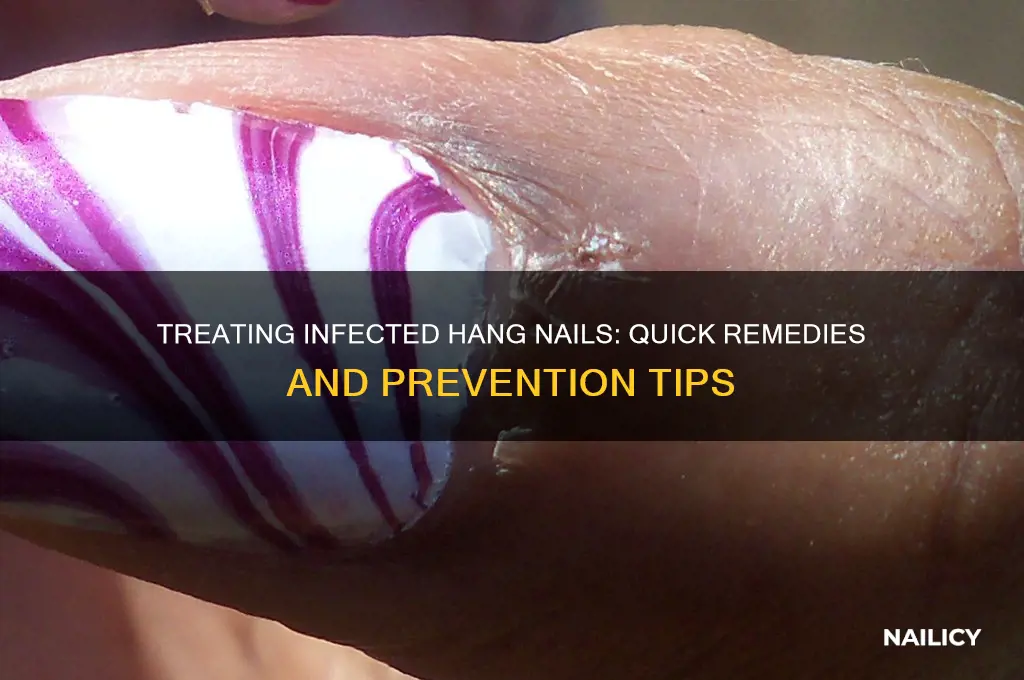 Treating Infected Hang Nails: Quick Remedies And Prevention Tips | Nailicy