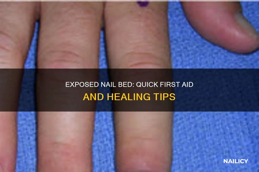 Exposed Nail Bed: Quick First Aid And Healing Tips | Nailicy