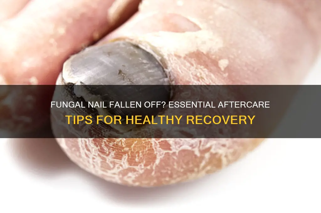 Fungal Nail Fallen Off? Essential Aftercare Tips For Healthy Recovery ...