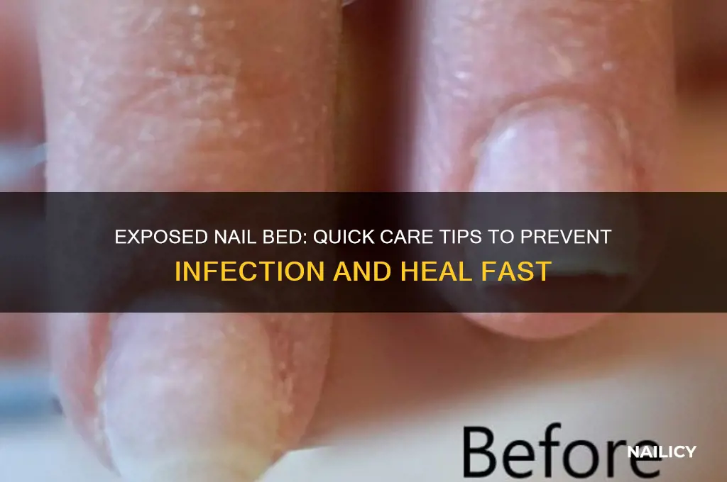 Exposed Nail Bed: Quick Care Tips To Prevent Infection And Heal Fast ...