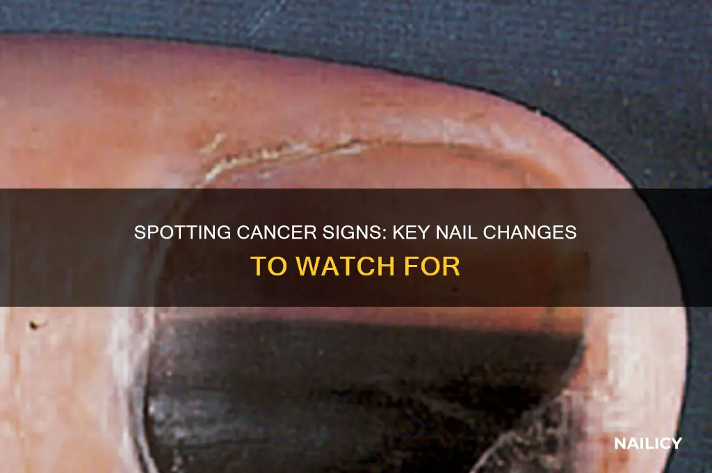 Spotting Cancer Signs: Key Nail Changes To Watch For | Nailicy