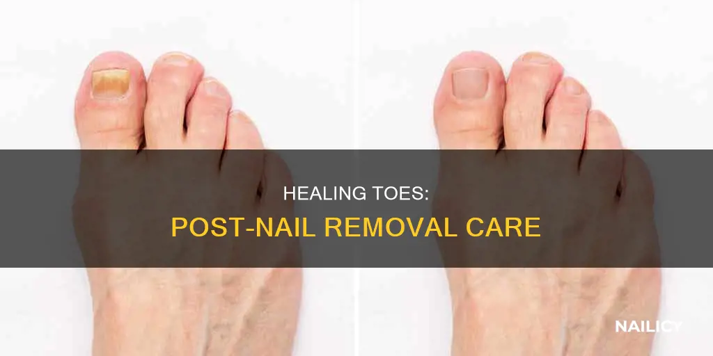 Healing Toes: Post-Nail Removal Care | Nailicy