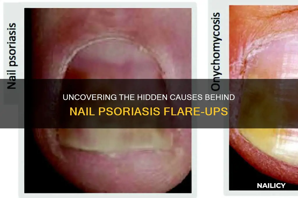 Uncovering The Hidden Causes Behind Nail Psoriasis Flare-Ups | Nailicy
