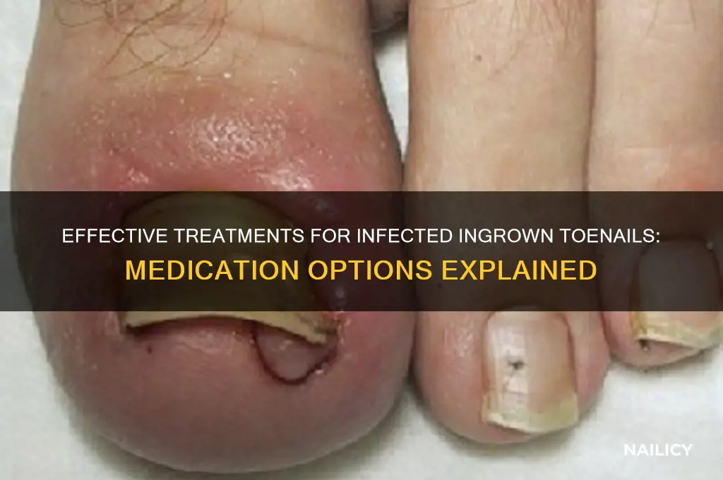 Effective Treatments For Infected Ingrown Toenails: Medication Options ...
