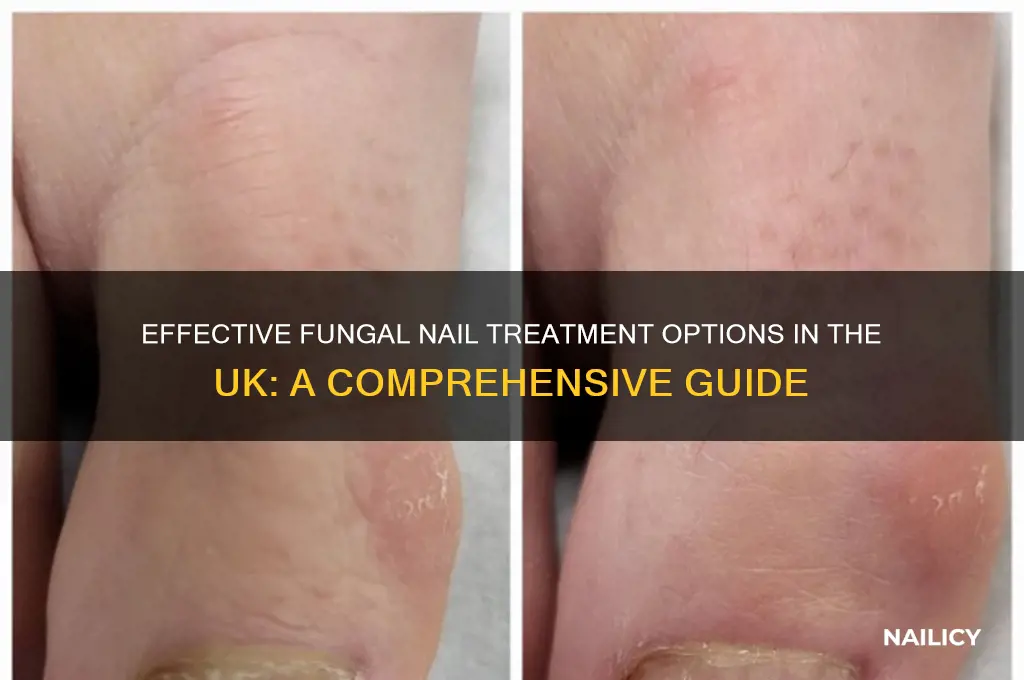 Effective Fungal Nail Treatment Options In The Uk: A Comprehensive ...
