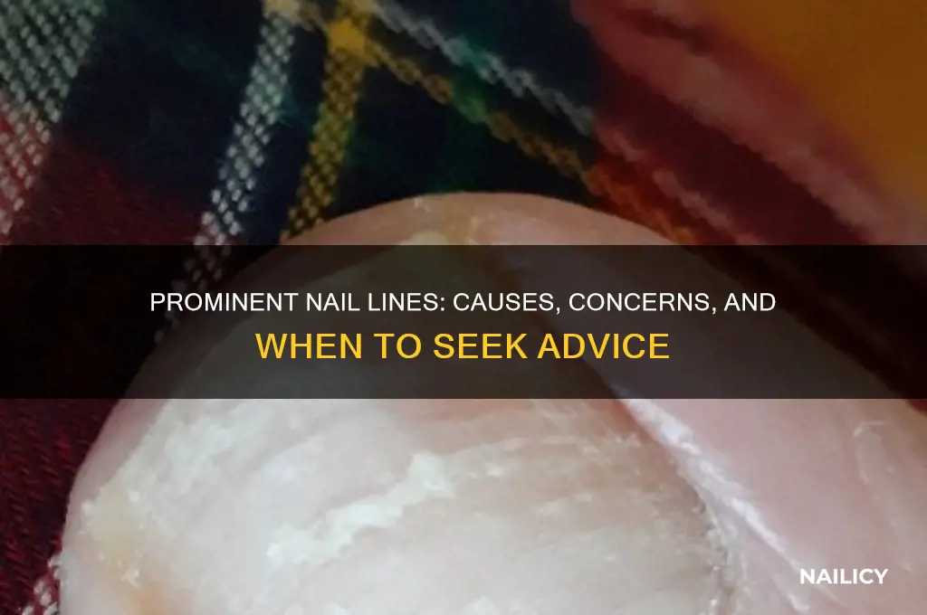 Prominent Nail Lines: Causes, Concerns, And When To Seek Advice | Nailicy