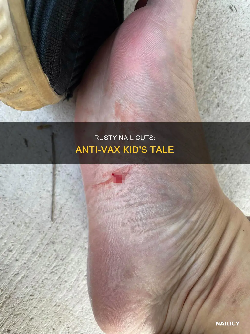 Rusty Nail Cuts: Anti-Vax Kid's Tale | Nailicy
