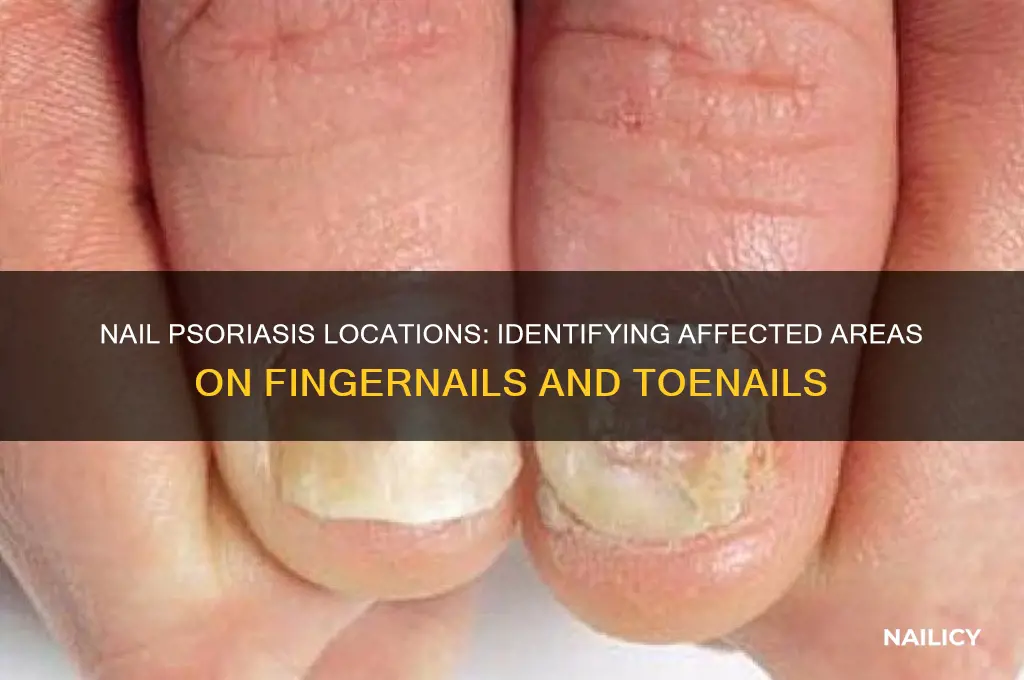 Nail Psoriasis Locations: Identifying Affected Areas On Fingernails And ...