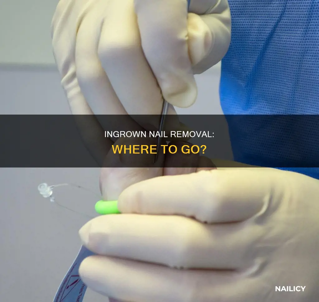 Ingrown Nail Removal: Where To Go? | Nailicy