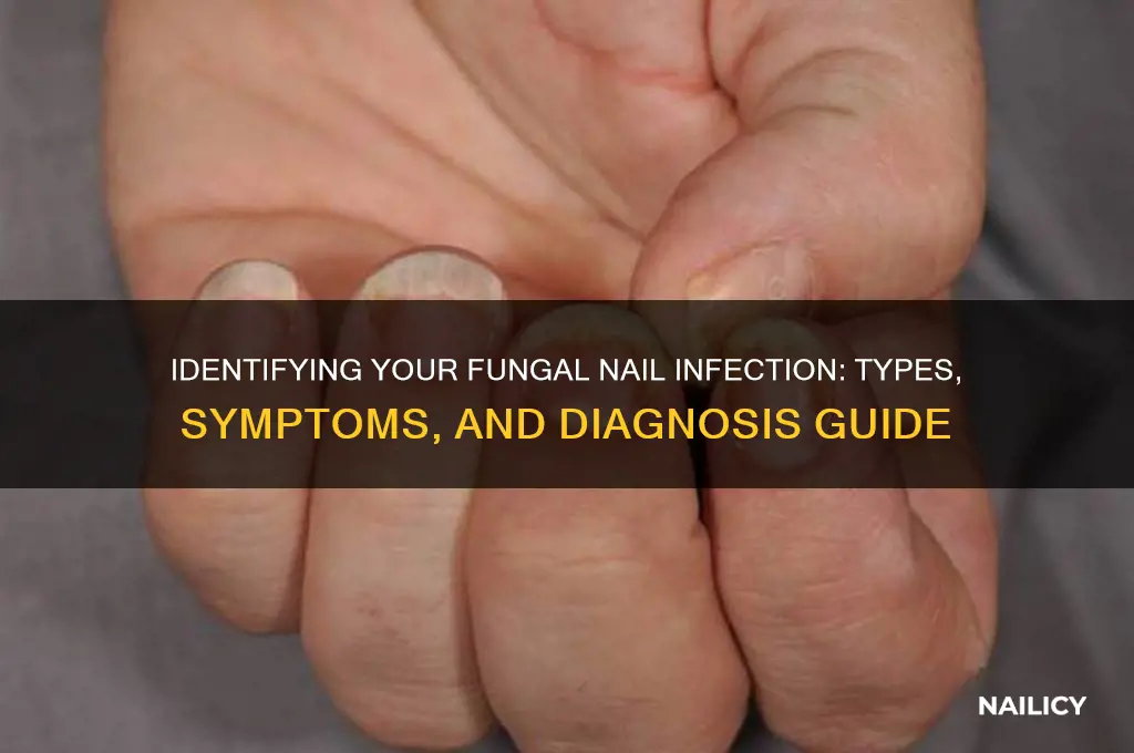 Identifying Your Fungal Nail Infection: Types, Symptoms, And Diagnosis ...