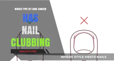 Nail Clubbing And Lung Cancer: Identifying The Associated Type | Nailicy