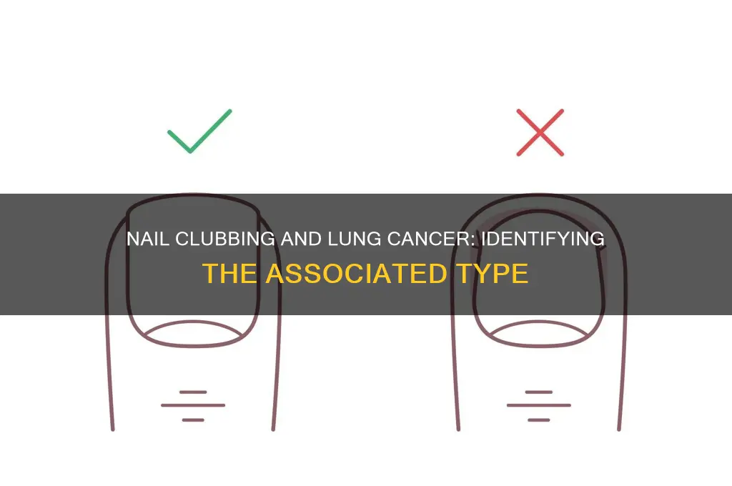 Nail Clubbing And Lung Cancer: Identifying The Associated Type | Nailicy