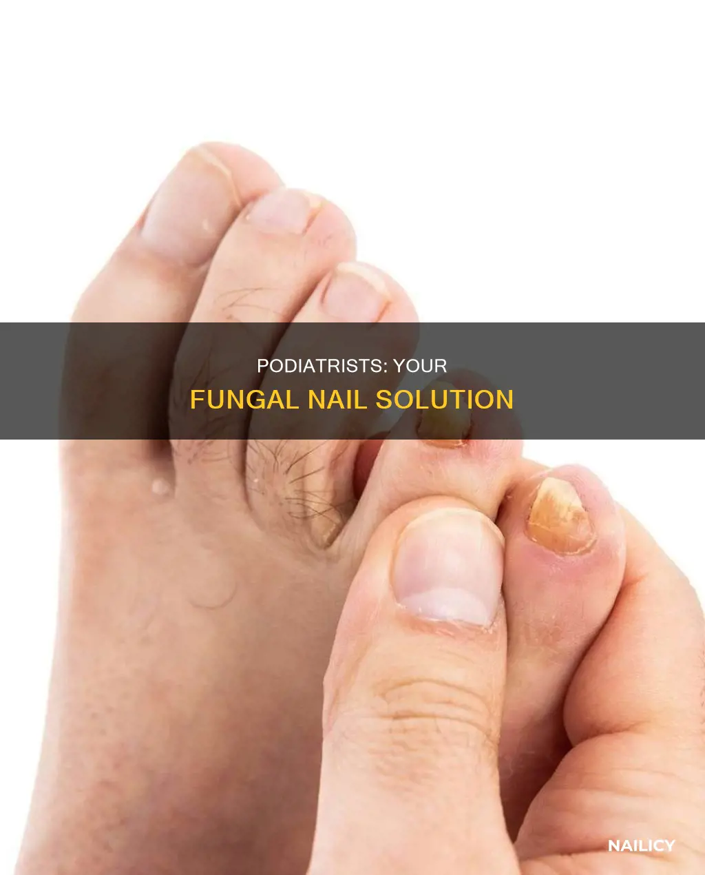 Podiatrists: Your Fungal Nail Solution | Nailicy