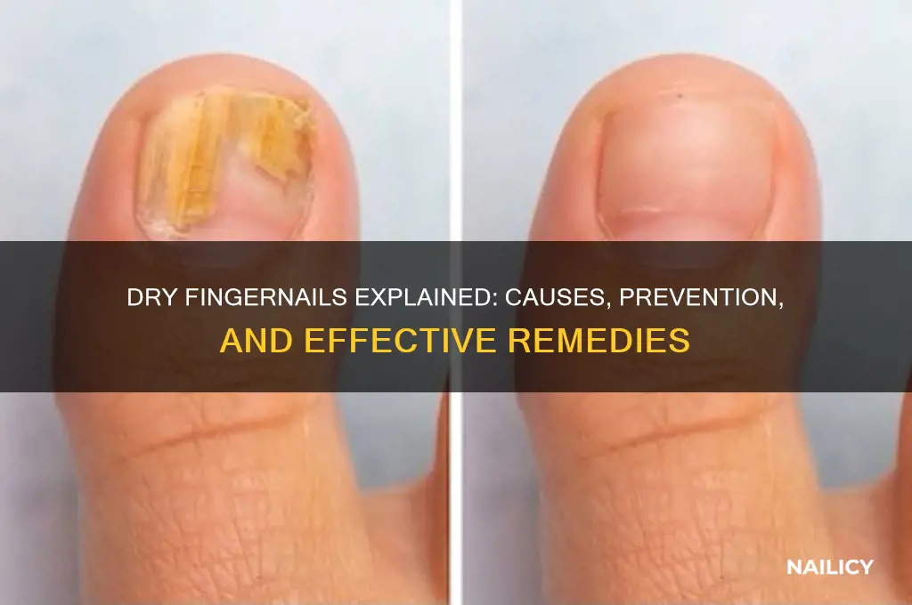 Dry Fingernails Explained: Causes, Prevention, And Effective Remedies ...