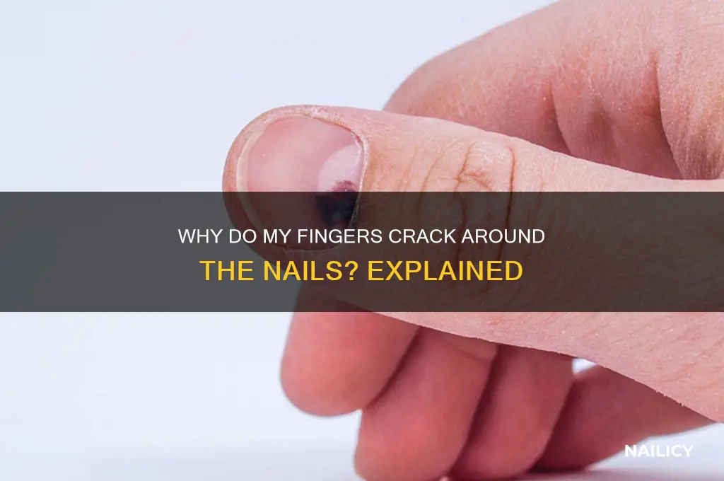Why Do My Fingers Crack Around The Nails? Explained | Nailicy