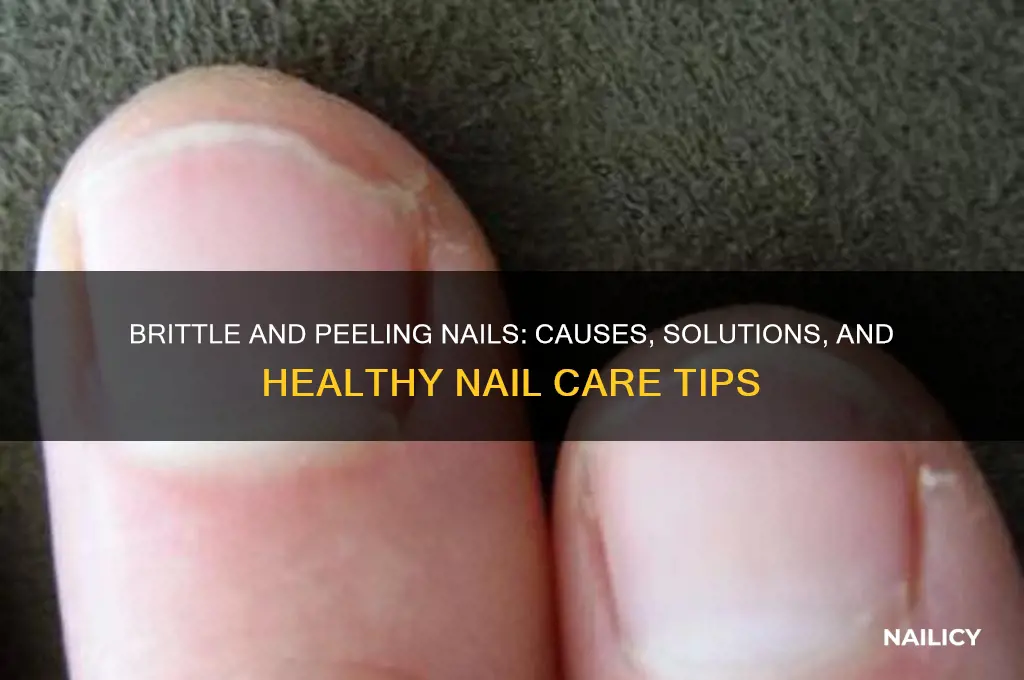 Brittle And Peeling Nails: Causes, Solutions, And Healthy Nail Care ...