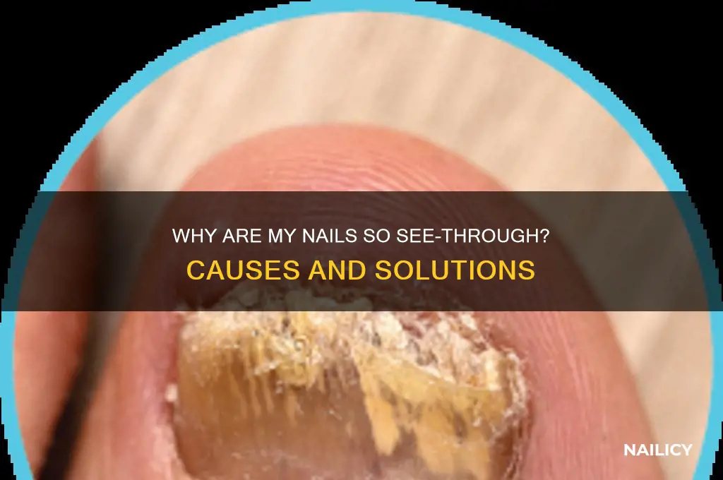 Why Are My Nails So See-Through? Causes And Solutions | Nailicy