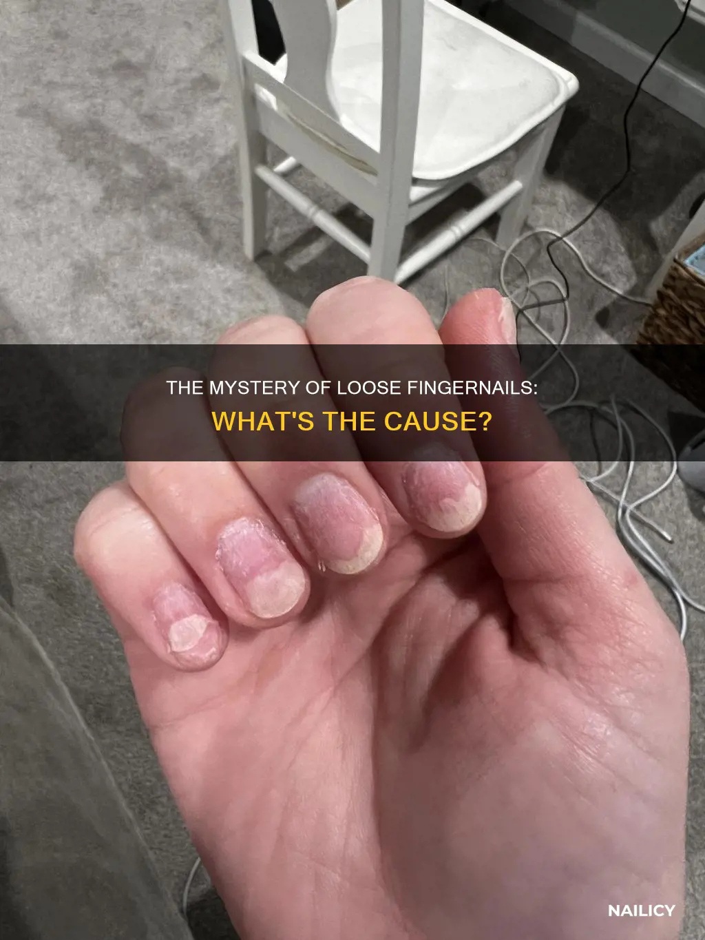 The Mystery Of Loose Fingernails: What's The Cause? | Nailicy