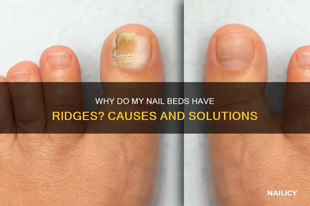 Why Do My Nail Beds Have Ridges? Causes And Solutions | Nailicy