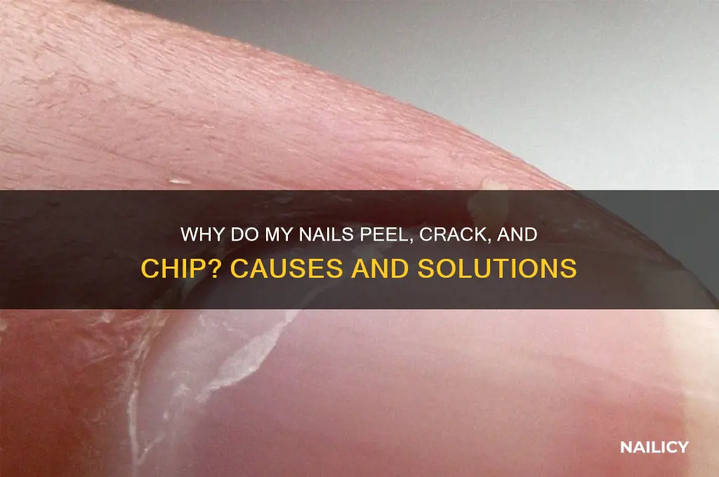 Why Do My Nails Peel, Crack, And Chip? Causes And Solutions | Nailicy