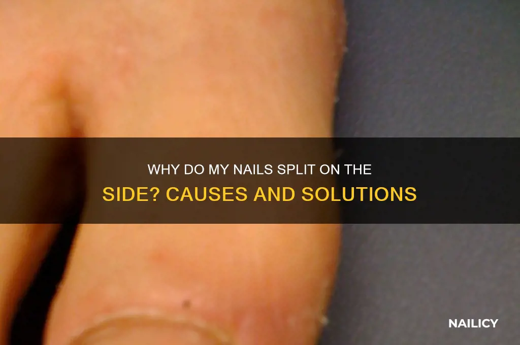 Why Do My Nails Split On The Side? Causes And Solutions | Nailicy