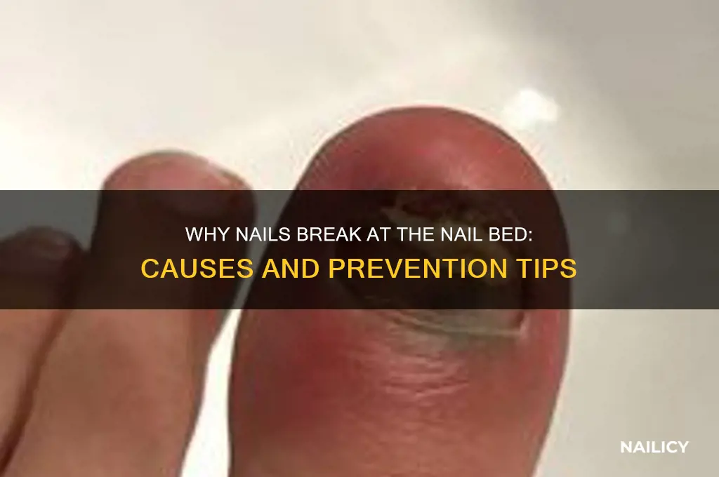 Why Nails Break At The Nail Bed: Causes And Prevention Tips | Nailicy