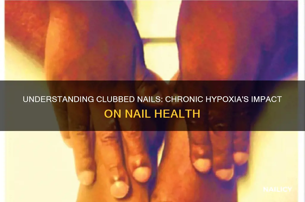 Understanding Clubbed Nails: Chronic Hypoxia's Impact On Nail Health ...