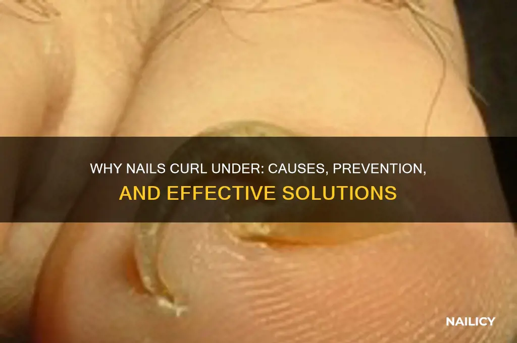 Why Nails Curl Under: Causes, Prevention, And Effective Solutions | Nailicy