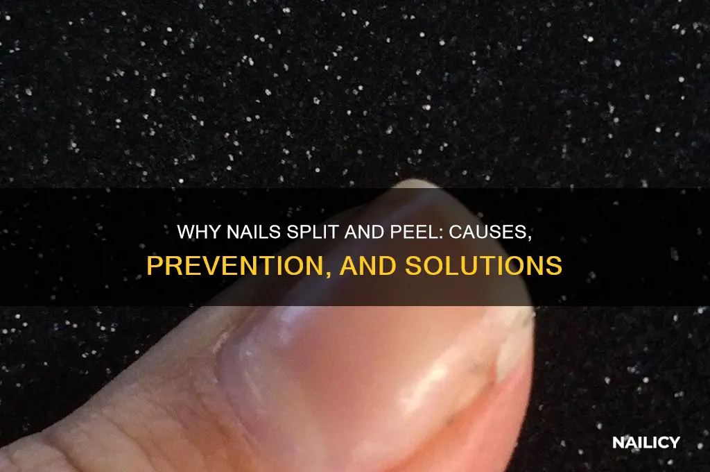 Why Nails Split And Peel: Causes, Prevention, And Solutions | Nailicy