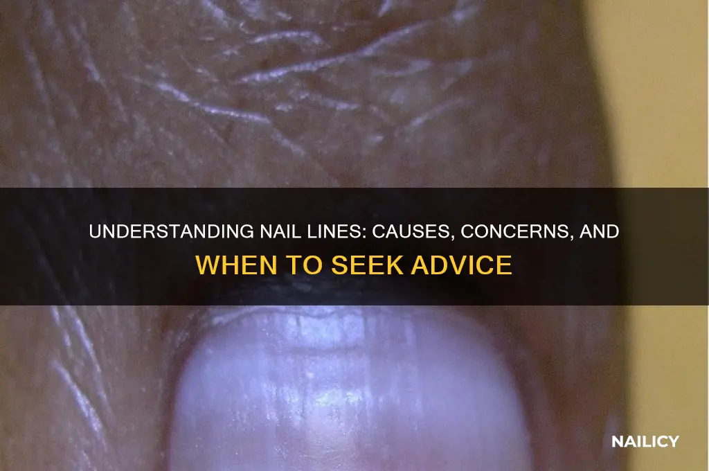 Understanding Nail Lines: Causes, Concerns, And When To Seek Advice ...