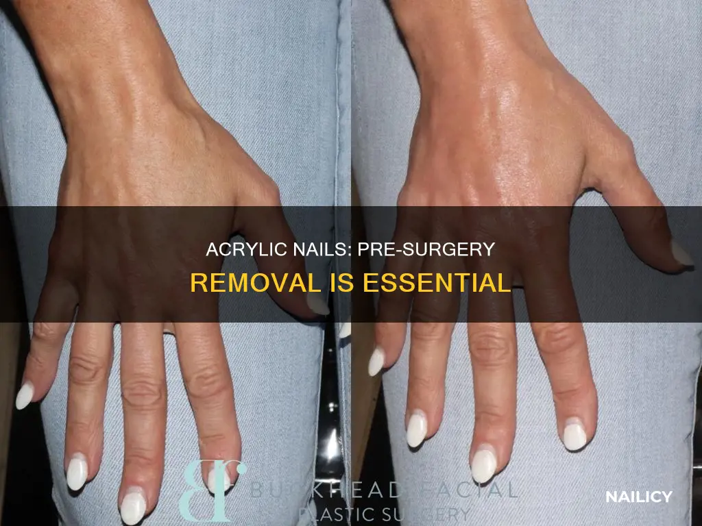 Acrylic Nails: Pre-Surgery Removal Is Essential | Nailicy