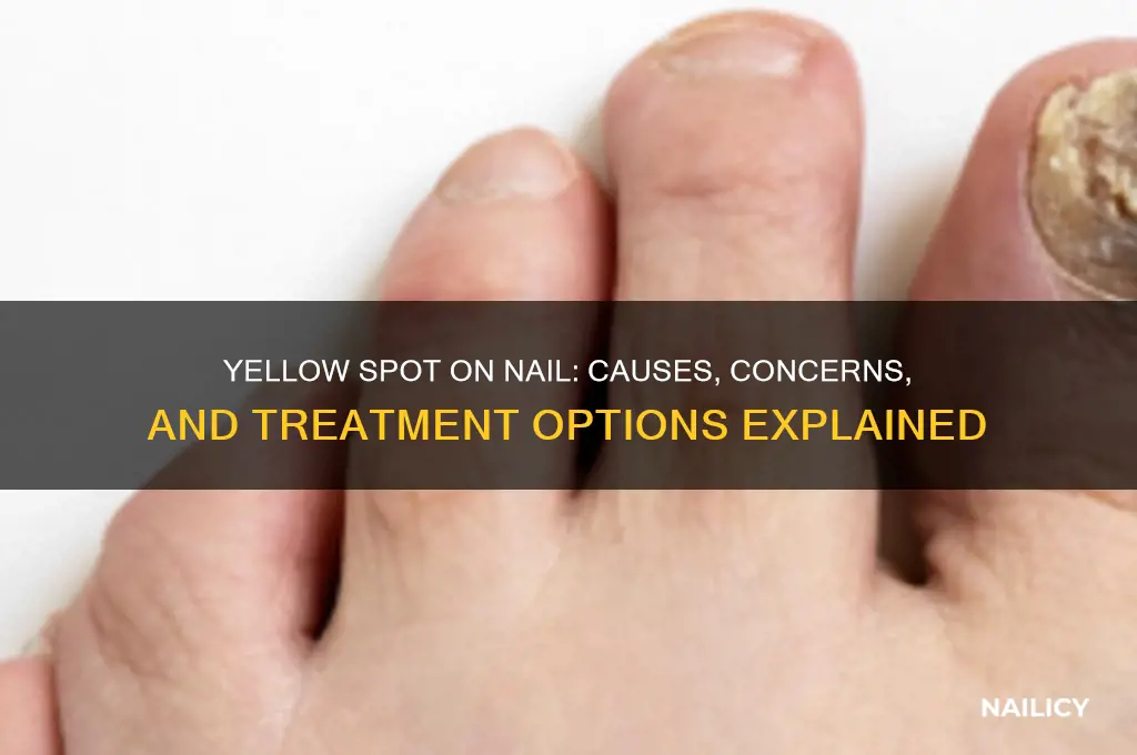 Yellow Spot On Nail: Causes, Concerns, And Treatment Options Explained ...