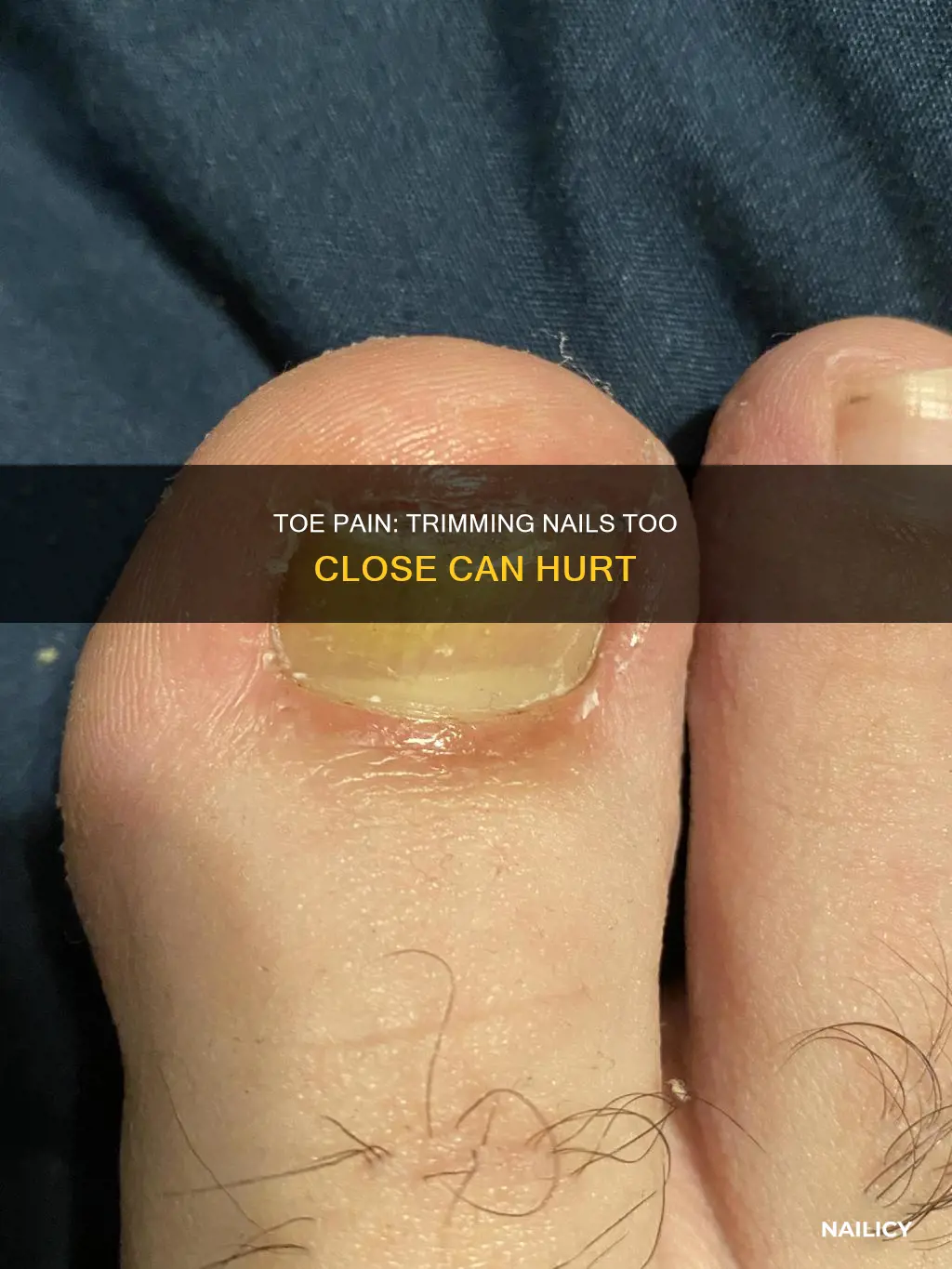 Toe Pain: Trimming Nails Too Close Can Hurt | Nailicy
