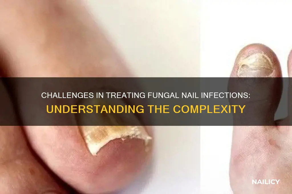 Challenges In Treating Fungal Nail Infections: Understanding The ...