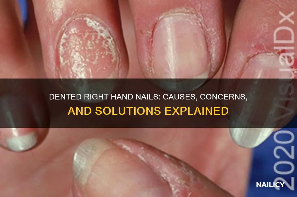 Dented Right Hand Nails: Causes, Concerns, And Solutions Explained ...