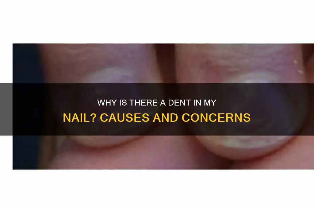 Why Is There A Dent In My Nail? Causes And Concerns | Nailicy
