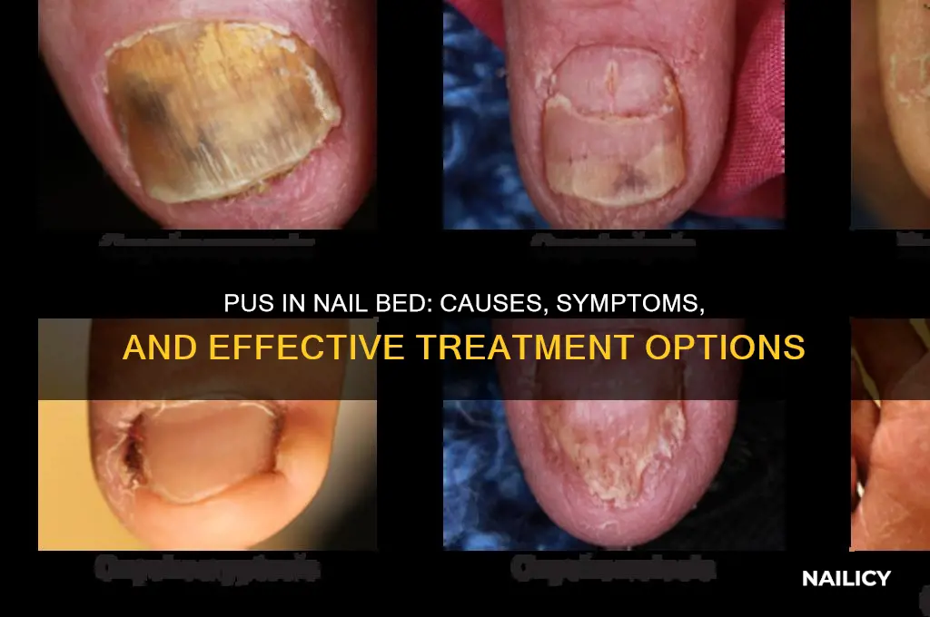 Pus In Nail Bed: Causes, Symptoms, And Effective Treatment Options ...