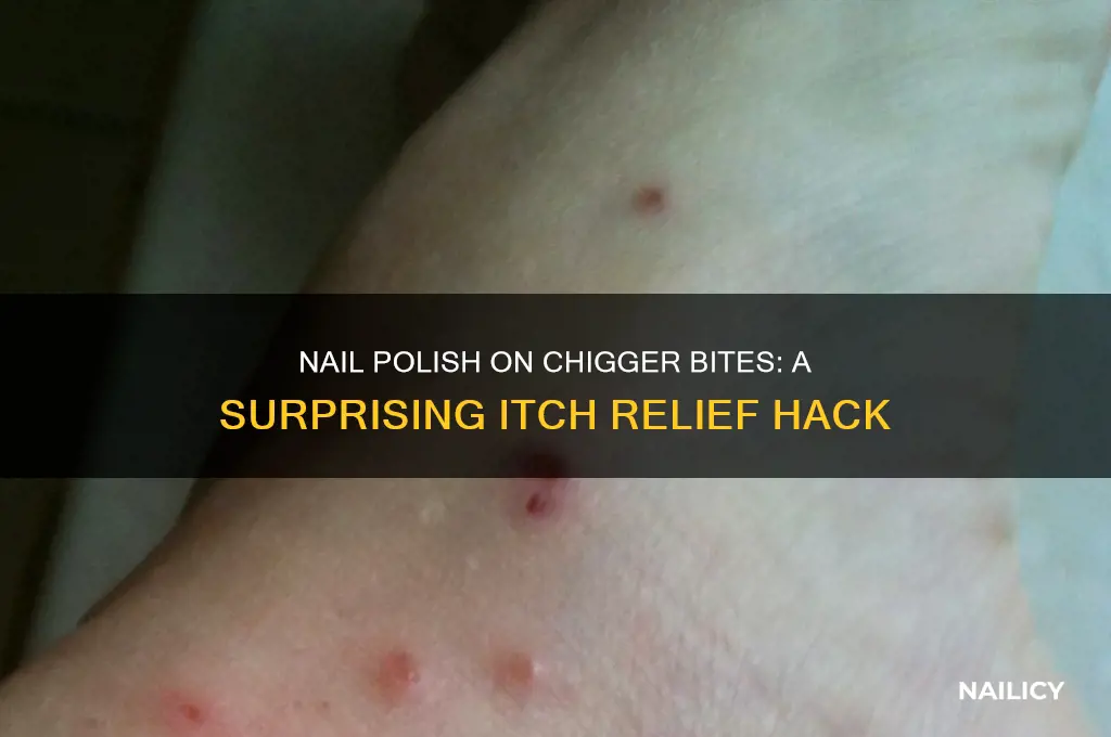 Nail Polish On Chigger Bites: A Surprising Itch Relief Hack | Nailicy