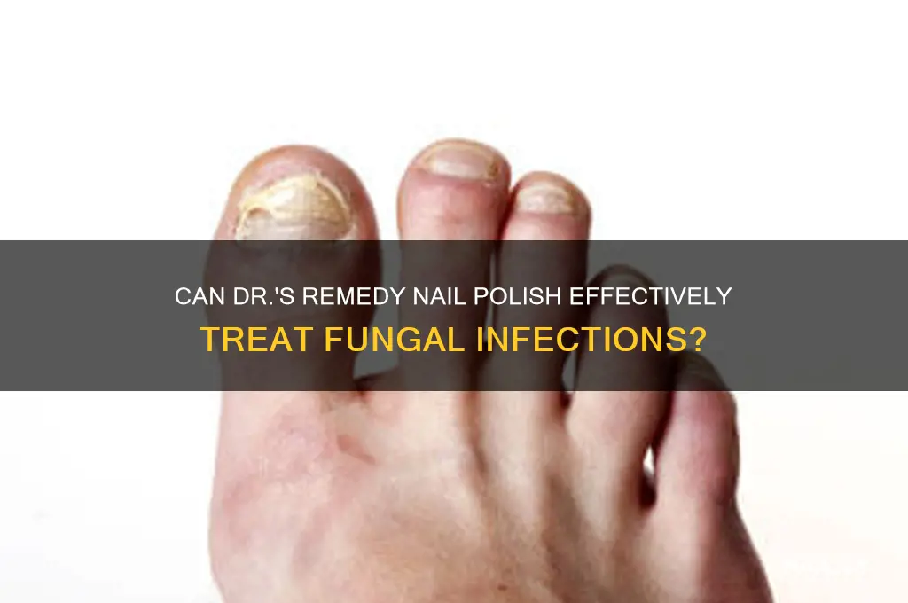 Can Dr.'S Remedy Nail Polish Effectively Treat Fungal Infections? | Nailicy